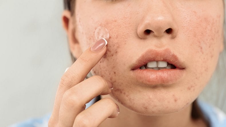 Do pimple patches really help with faster healing?